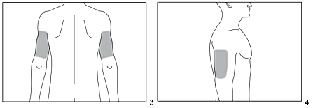 Lonquex 6 mg Injektionslösung in einer Fertigspritze - ratiopharm GmbH