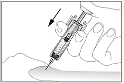 Lonquex 6 mg Injektionslösung in einer Fertigspritze - ratiopharm GmbH